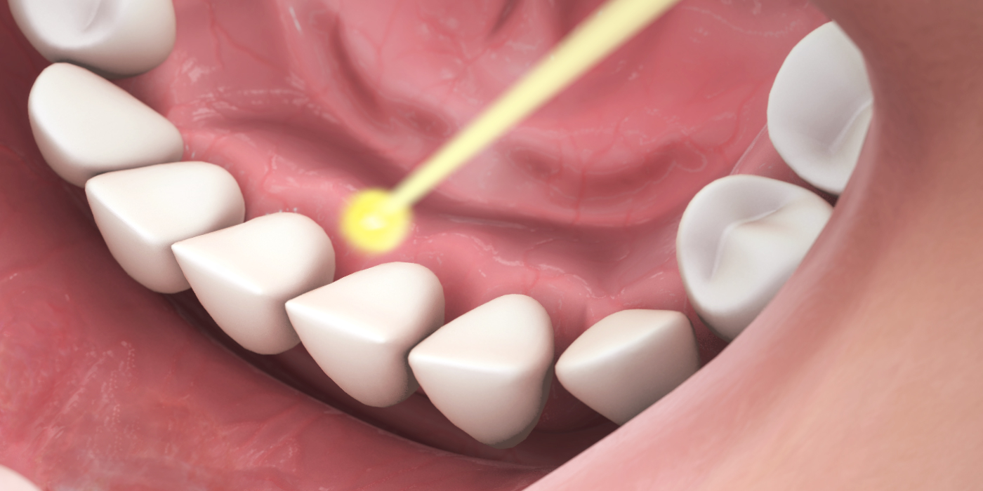Soft-Tissue Dental Surgery - Access Laser